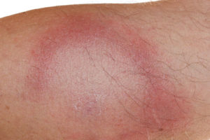 Piqure de tique erytheme migrant - Solution Cimex