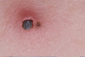 Comment reconnaître une piqûre de tique - Solution Cimex